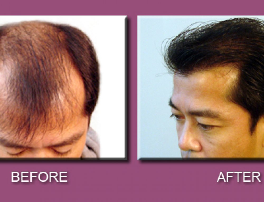 How We Perform This FUSS Hair MicroGraftInThe A Man Alopecia