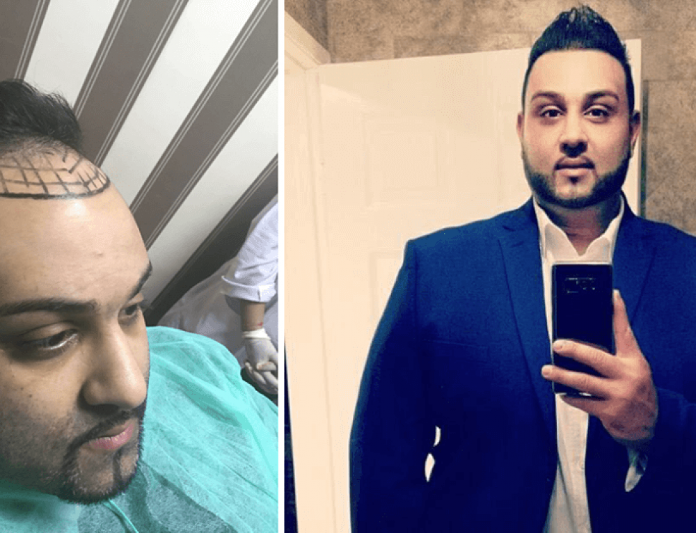 How We Perform This FUSS Hair MicroGraftInThe A Man Alopecia