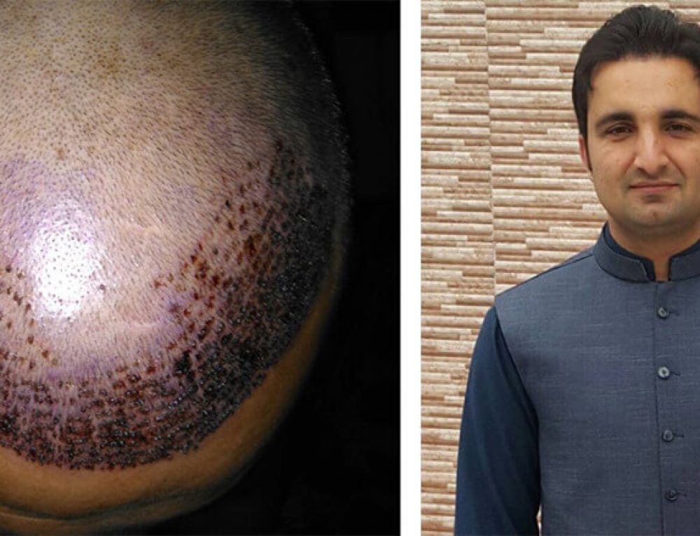 How We Perform This FUSS Hair MicroGraftInThe A Man Alopecia